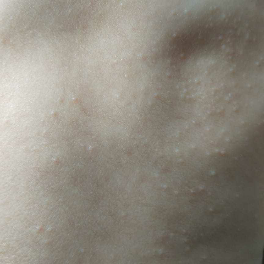 Hello,Mg baby is 5 months old now he got heat rashes on neck now to get ...