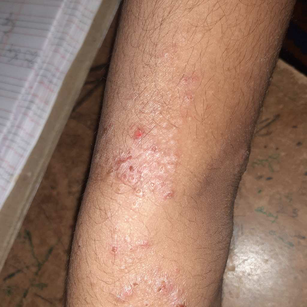 Hello Doctor, My son is 15 months old and has got rash on back of his ...