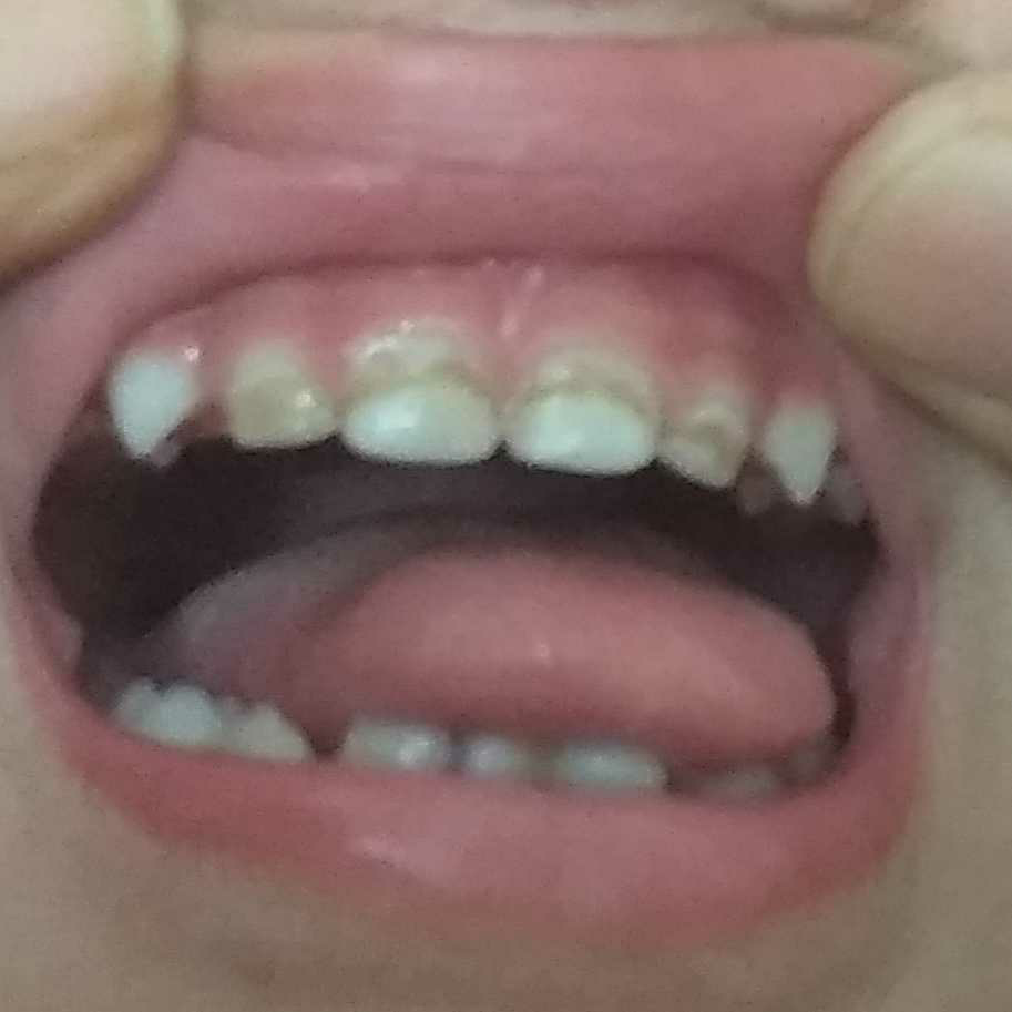 my daughter's upper teeth became rough. There are scratches on the ...