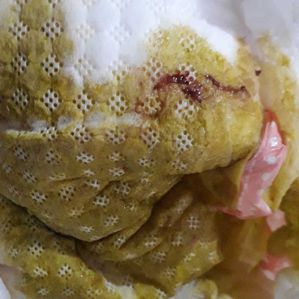 hi mam my 2 months baby hv loose motion and I saw mucus n blood jelly ...