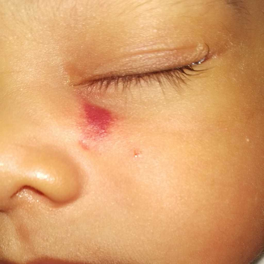 Red Spots On Baby Face Red Spots On Baby Face