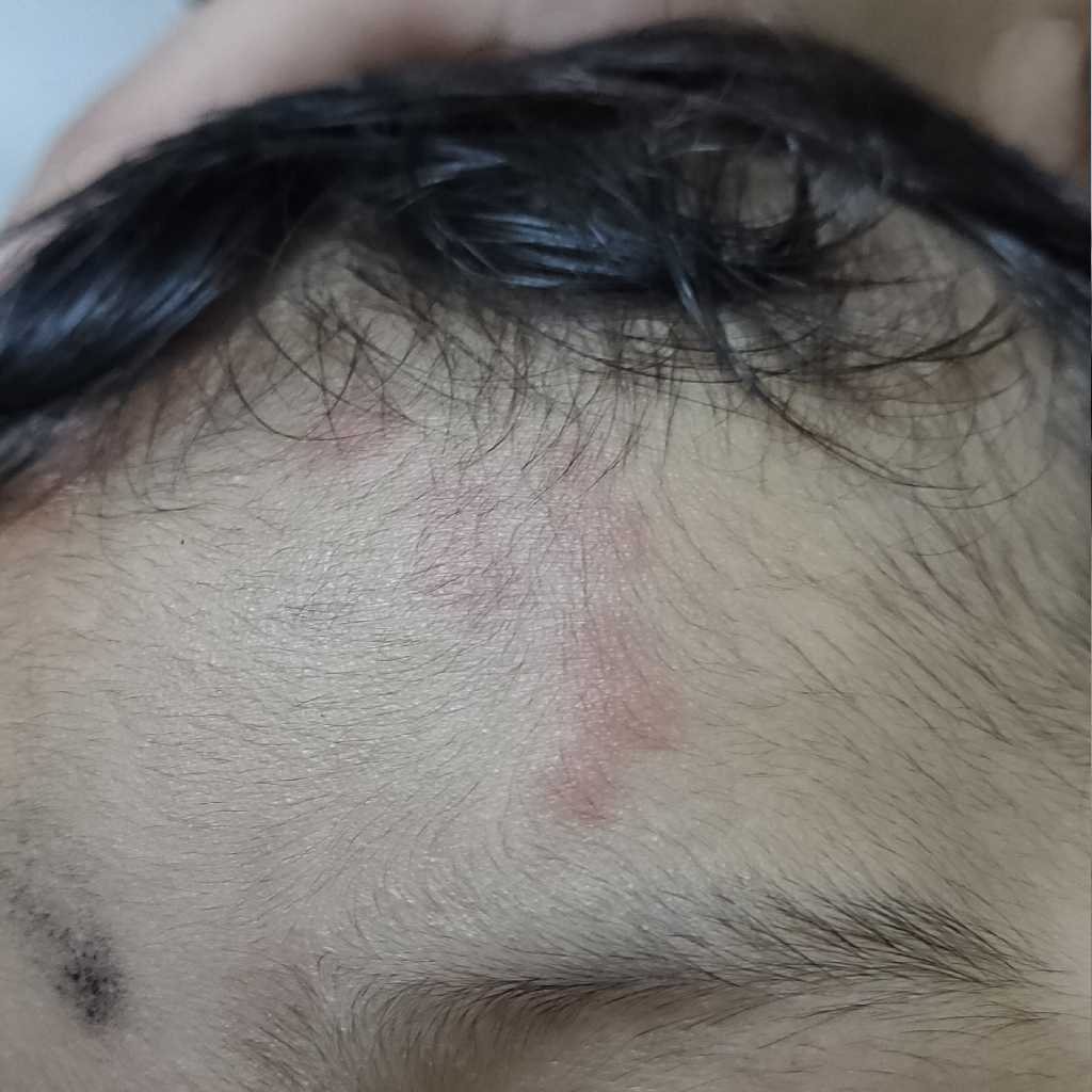 My baby have light pink marks on her forehead and blue spots on her ...