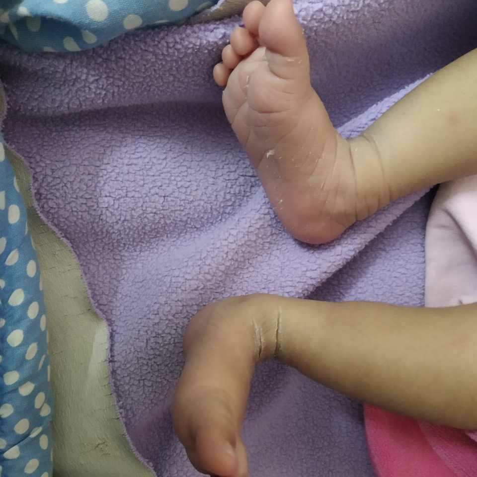 My 4 month so baby's feet of one leg is slightly bended inwards from ...