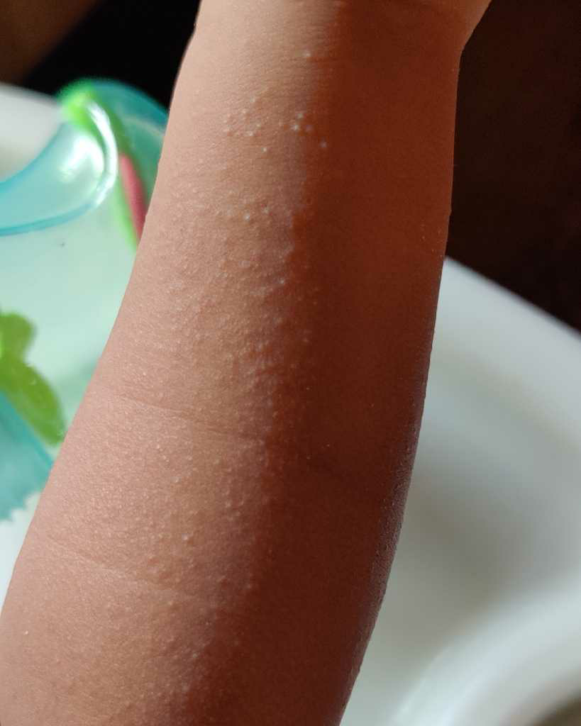 I am having a 10 days old daughter and she is having small boil on her ...