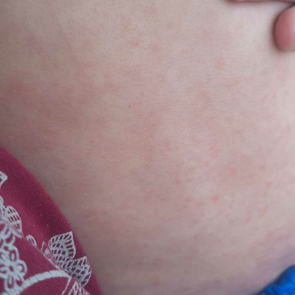 #AskTheExpert rashes on face, back and front in first trimester of ...