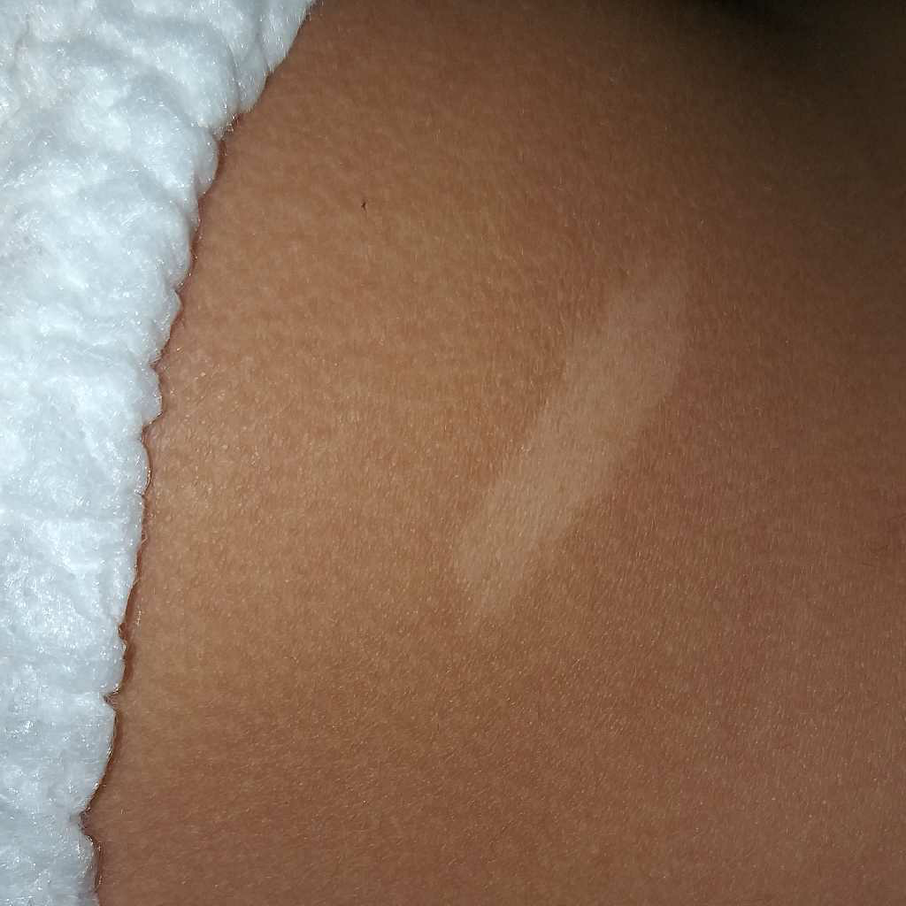 #ParentingClinic mere baby ke private part pe swelling ho gye h wo abi ...