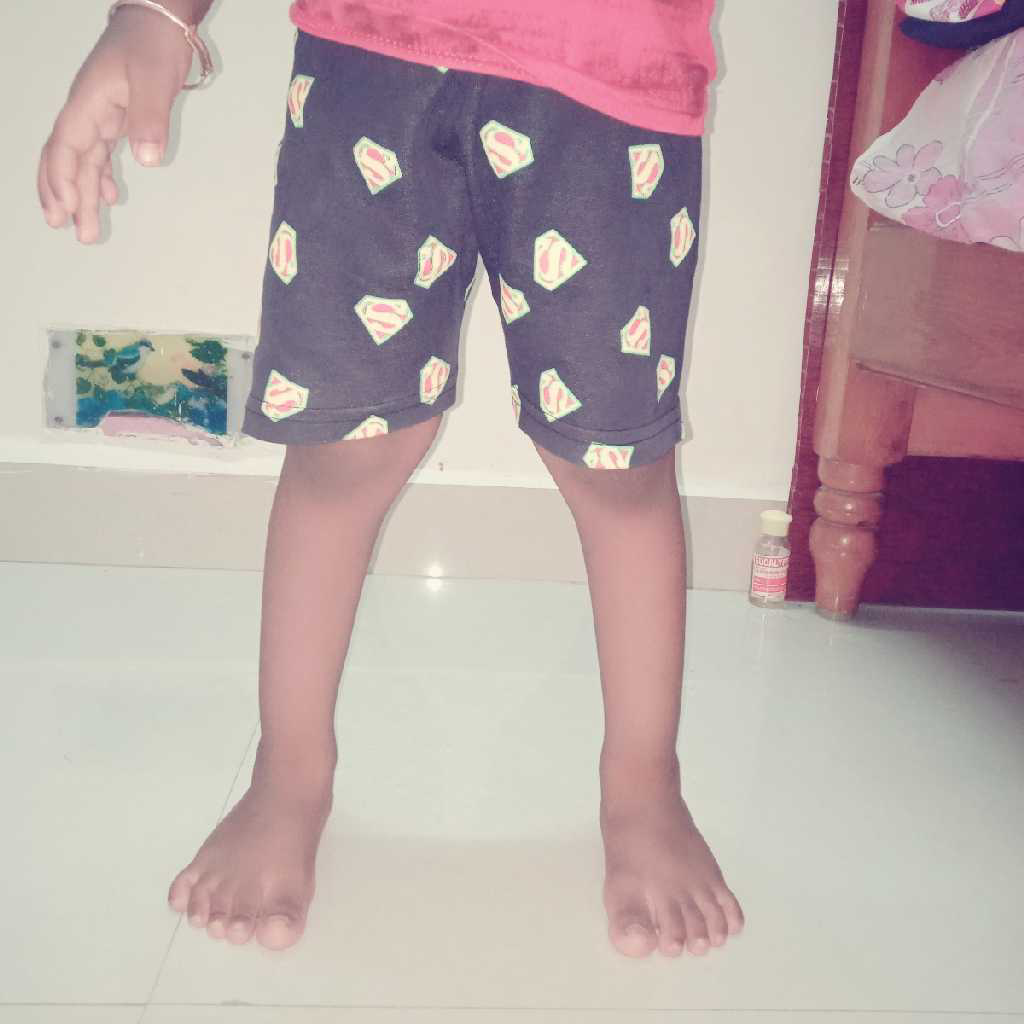 #AskTheExpert hi doctor my baby is 1yr old .her legs are now shaped .is ...