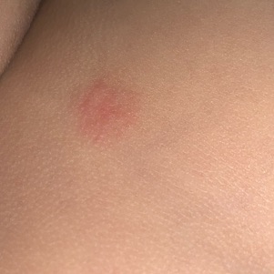 At first week a red small dot appeared on chest. the dot is spreading ...