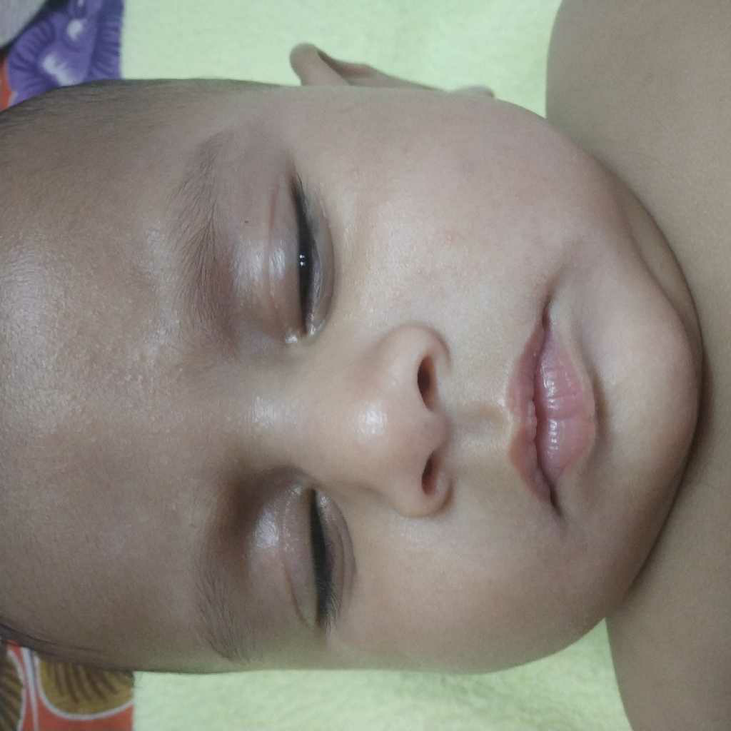 My baby is 7 month old.. Some kind of rash is formed on her face like ...