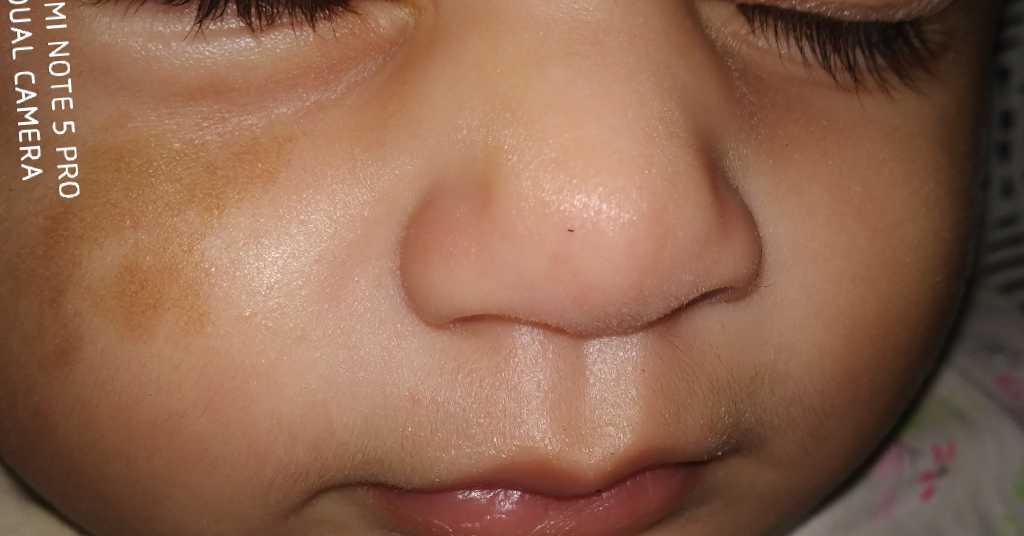 #AskTheExpert pls find what is that on my babys face doctor its doesnt ...