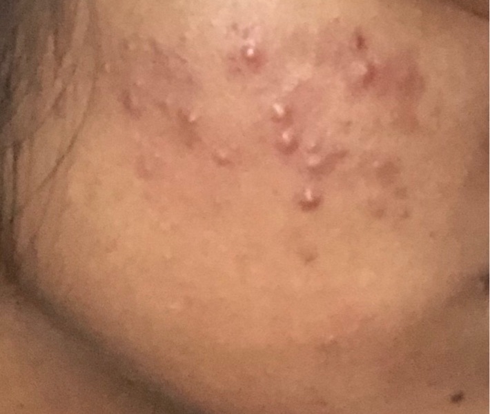 Hi Mam/Sir, my baby is getting rashes all over his neckand and its ...